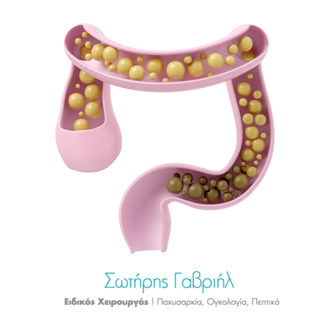 Πώς συνδέονται οι αιμορροΐδες με τη δυσκοιλιότητα;