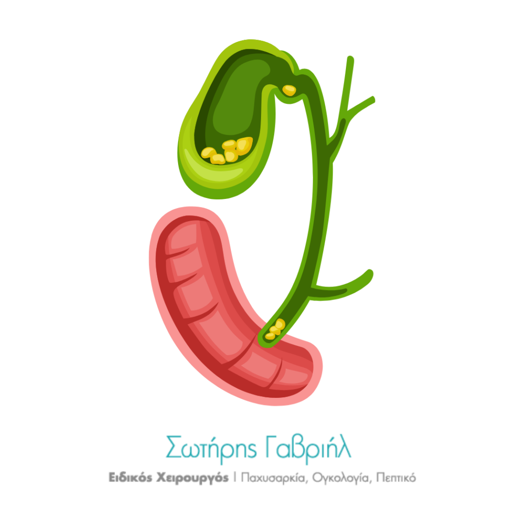 Πολύποδες στη Χολή | Εκτίμηση, Κίνδυνος & Θεραπεία